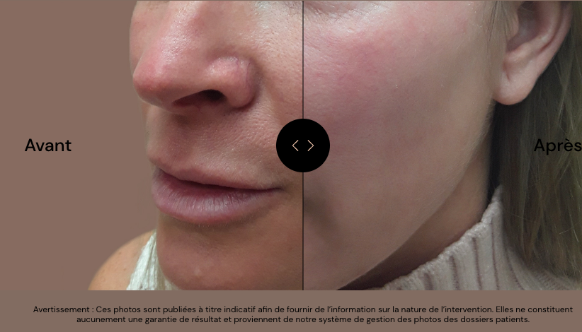 Adieu rougeurs, couperose, rosacée! - Les Radieuses